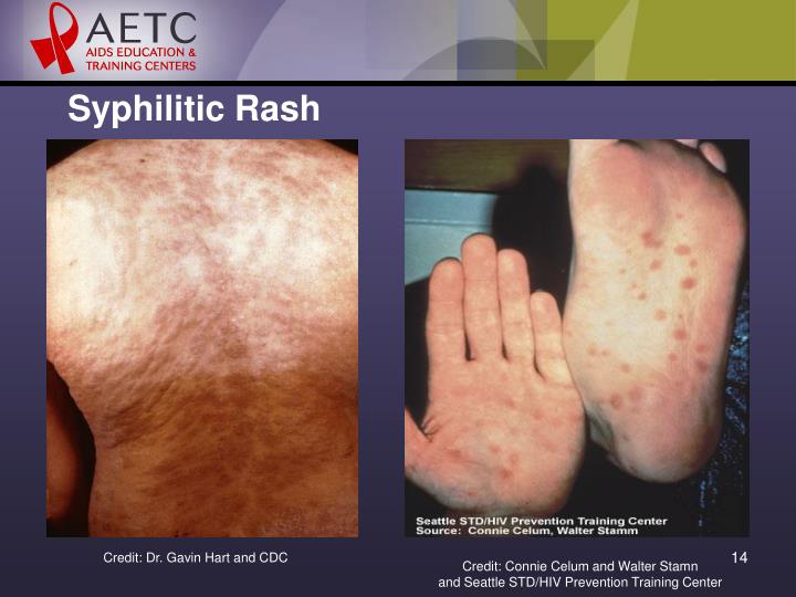 Ppt Common Sexually Transmitted Diseases Stds And Hiv Infected Women Powerpoint Presentation