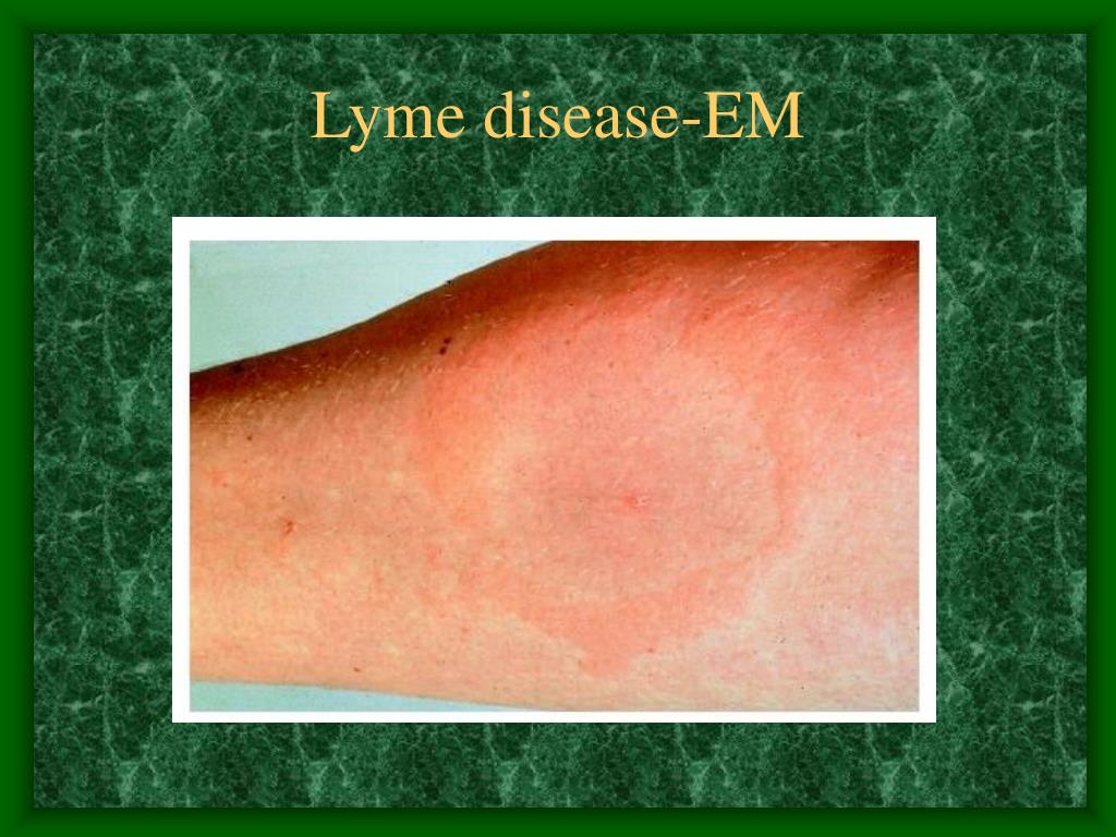 PPT - Lyme disease Lyme borreliosis PowerPoint Presentation, free ...