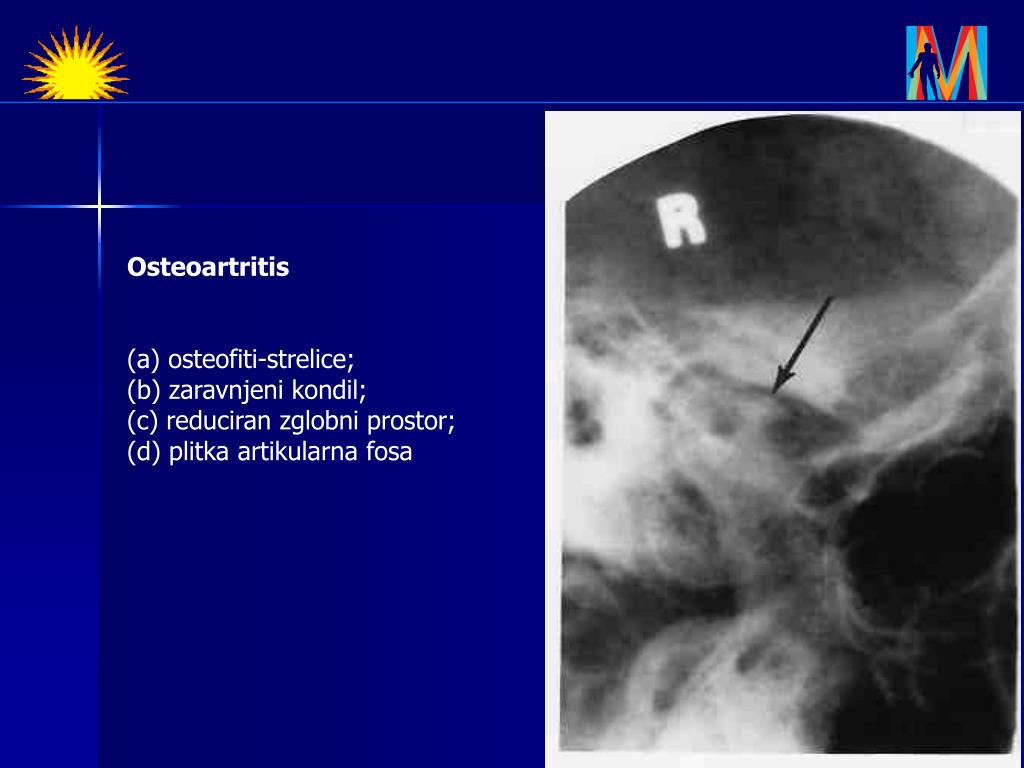PPT - Temporomandibularni zglob (TMZ) prof. dr. sc. Stipan Janković ...