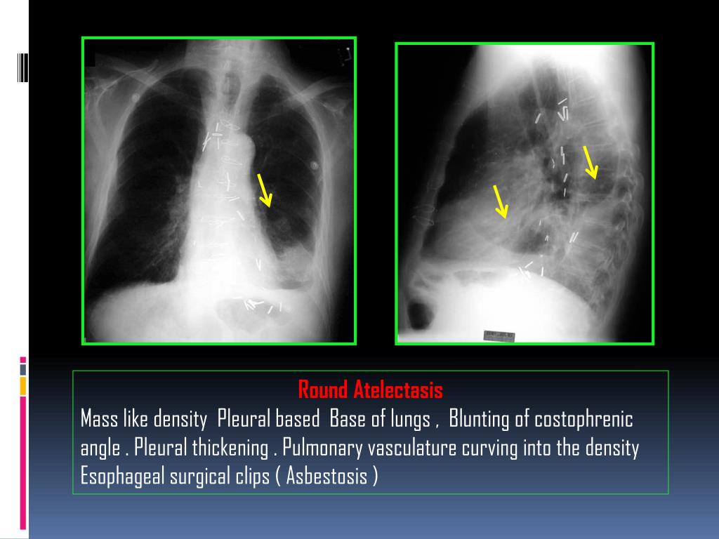 PPT - ATELEKTASIS Arimbi,Sp.P Ilmu Penyakit Dalam FK UWKS PowerPoint ...