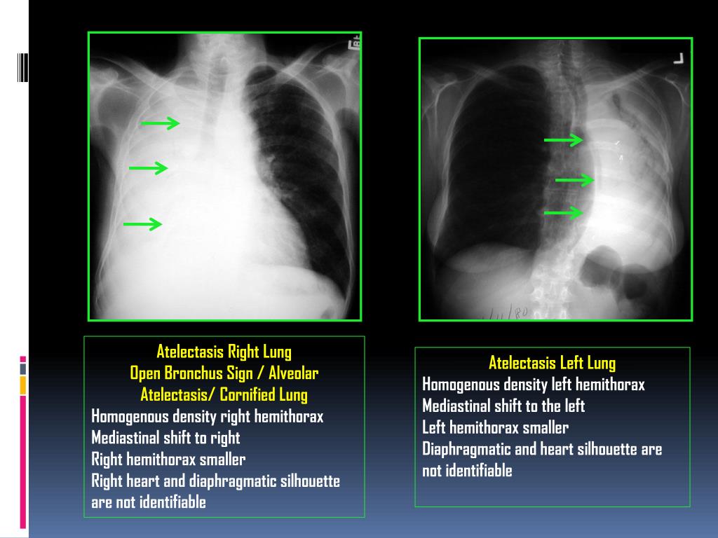 PPT - ATELEKTASIS Arimbi,Sp.P Ilmu Penyakit Dalam FK UWKS PowerPoint ...