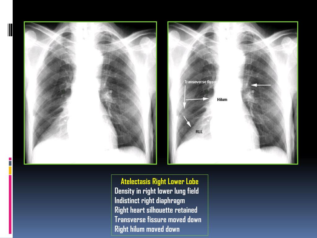 PPT - ATELEKTASIS Arimbi,Sp.P Ilmu Penyakit Dalam FK UWKS PowerPoint ...