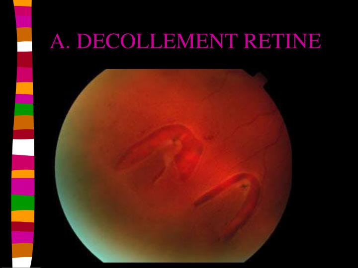 PPT - PATHOLOGIE DE LA RETINE PowerPoint Presentation - ID:4552458