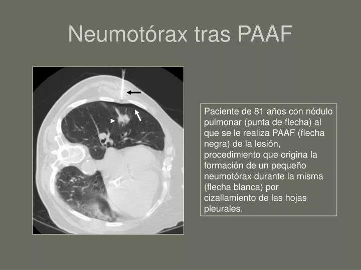 PPT - Neumotórax tras PAAF PowerPoint Presentation, free download - ID ...