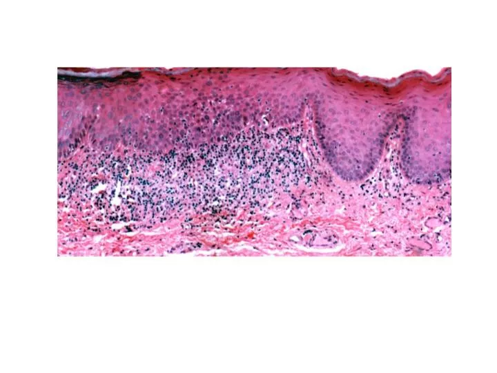 PPT - Hairy leukoplakia PowerPoint Presentation, free download - ID:4558215