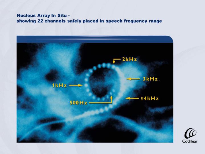 PPT - Auditory Brainstem Implant PowerPoint Presentation - ID:4558236