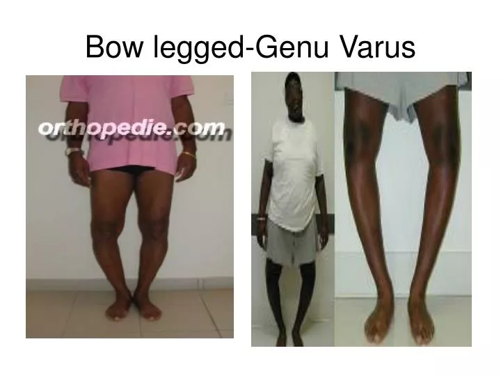 PPT - Bow legged-Genu Varus PowerPoint Presentation, free download - ID ...