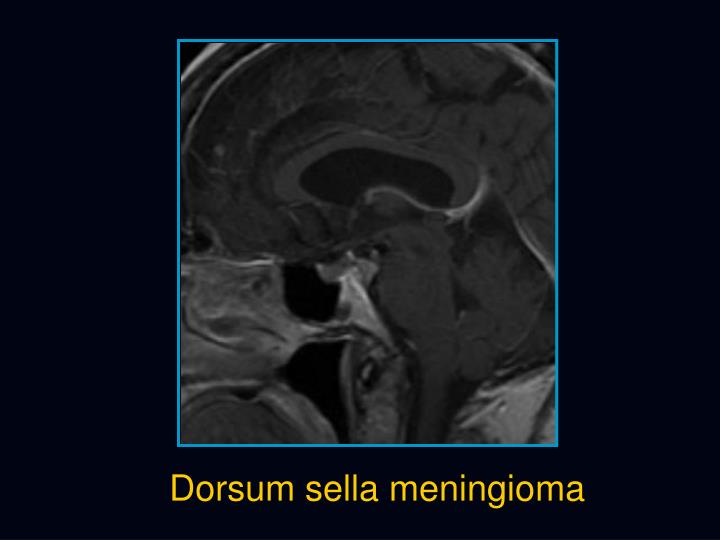 PPT - Sella turcica and parasellar region PowerPoint Presentation - ID ...