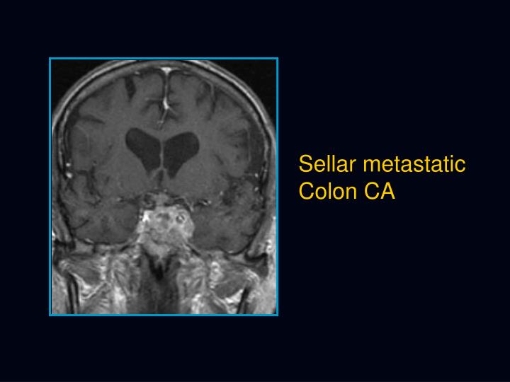 PPT - Sella turcica and parasellar region PowerPoint Presentation - ID ...