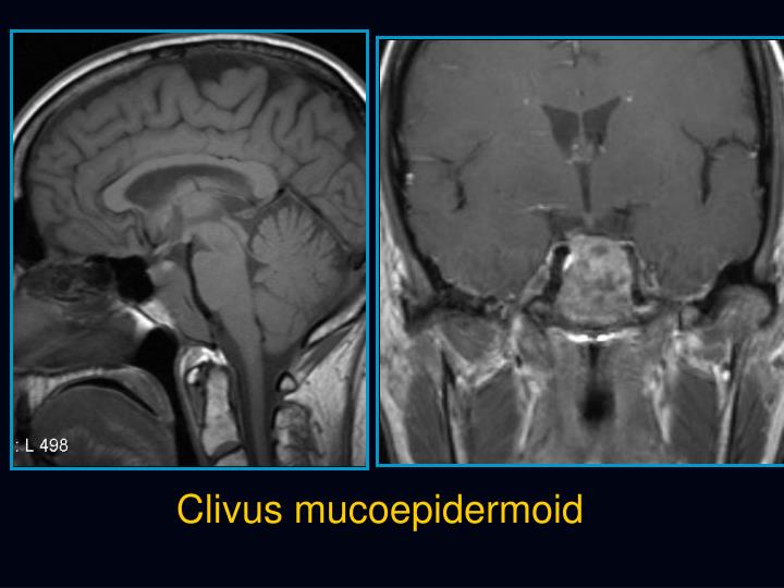 PPT - Sella turcica and parasellar region PowerPoint Presentation - ID ...