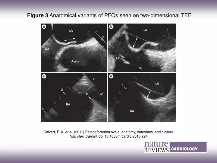 PPT - Figure 3 Anatomical variants of PFOs seen on two-dimensional TEE ...