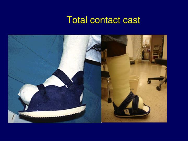 PPT - Charcot Arthropathy . PowerPoint Presentation - ID:4586043