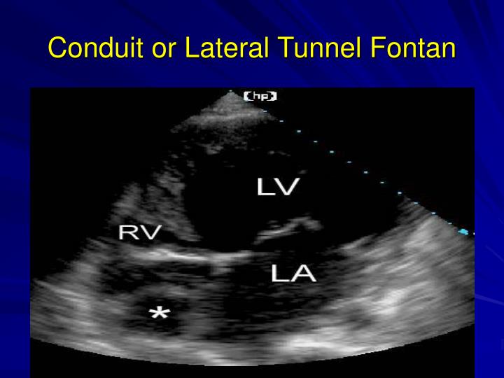 PPT - Congenital Heart Diseases II PowerPoint Presentation - ID:4589614