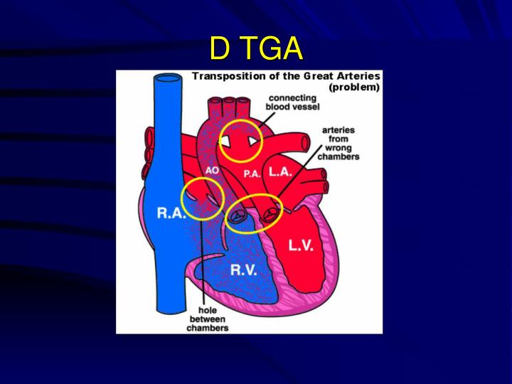 PPT - Congenital Heart Diseases II PowerPoint Presentation - ID:4589614