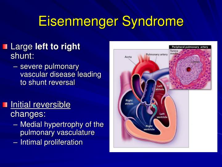 PPT - Congenital Heart Diseases II PowerPoint Presentation - ID:4589614