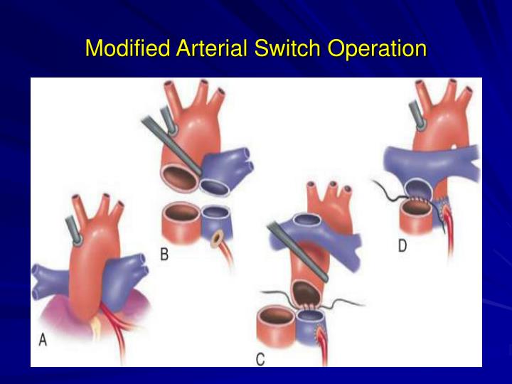 PPT - Congenital Heart Diseases II PowerPoint Presentation - ID:4589614