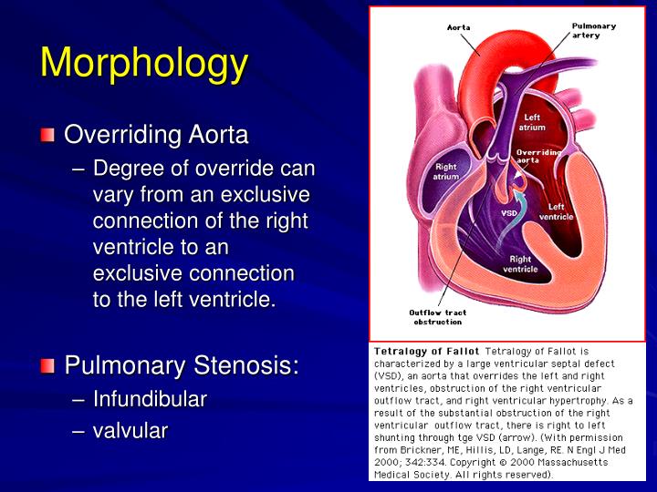 PPT - Congenital Heart Diseases II PowerPoint Presentation - ID:4589614