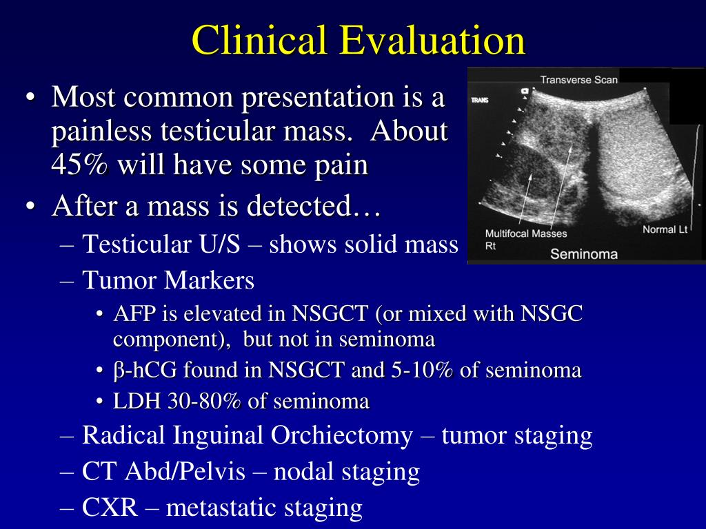 Ppt Testicular Seminoma Powerpoint Presentation Free Download Id