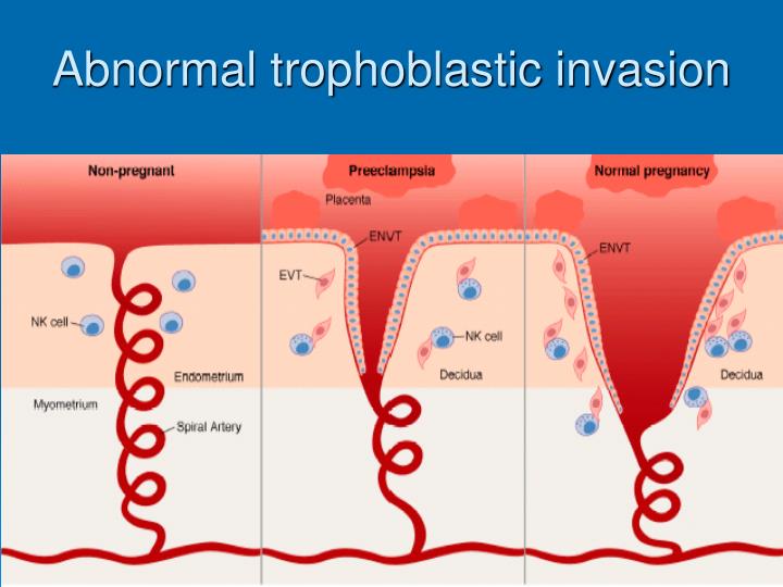 PPT - Hypertensive Disorders in Pregnancy PowerPoint Presentation - ID ...