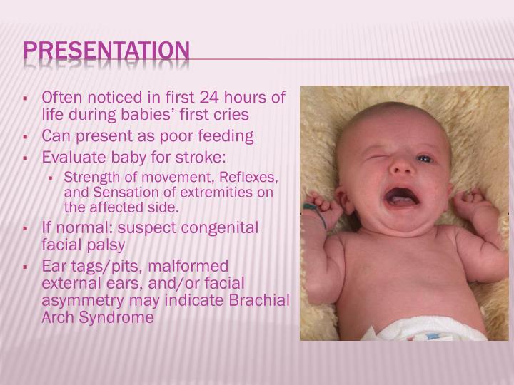 PPT - Facial Palsy PowerPoint Presentation - ID:4602806
