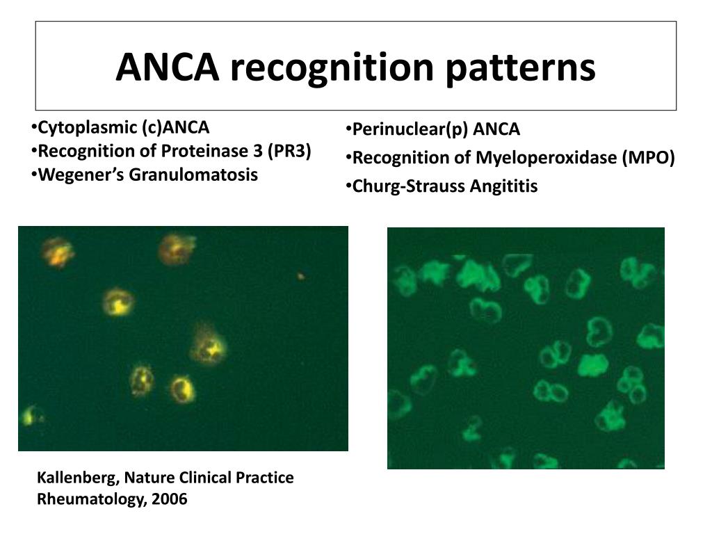 PPT - Churg -Strauss Syndrome: Dispelling the Myths PowerPoint ...