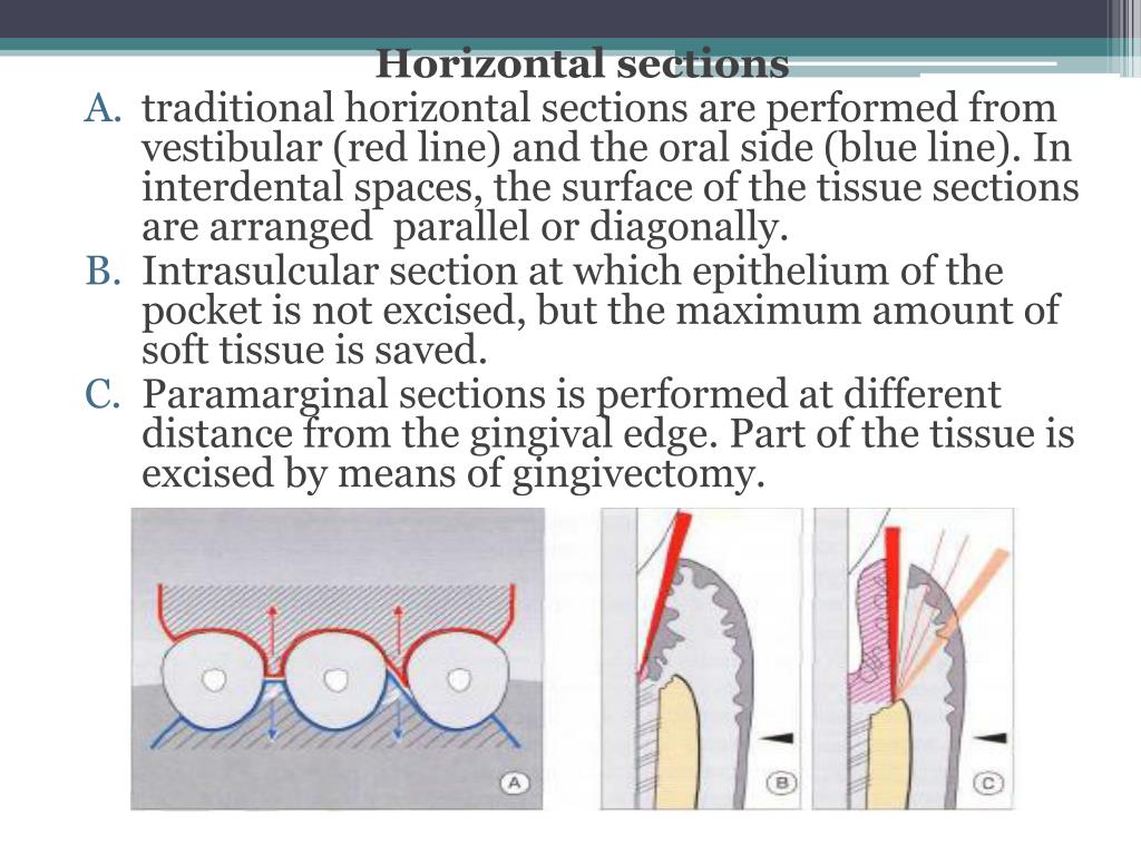 PPT - Surgical Periodontal Therapy PowerPoint Presentation, free ...