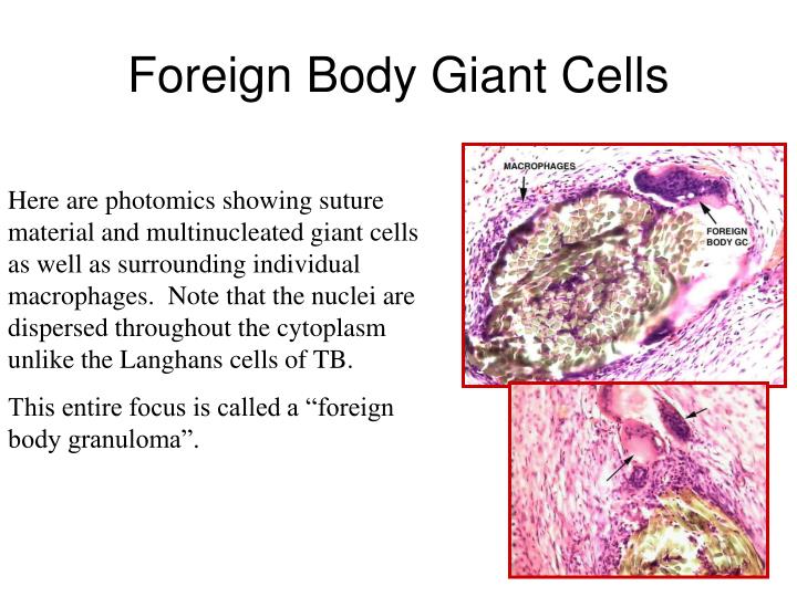 PPT - Periapical Granuloma PowerPoint Presentation - ID:4604077