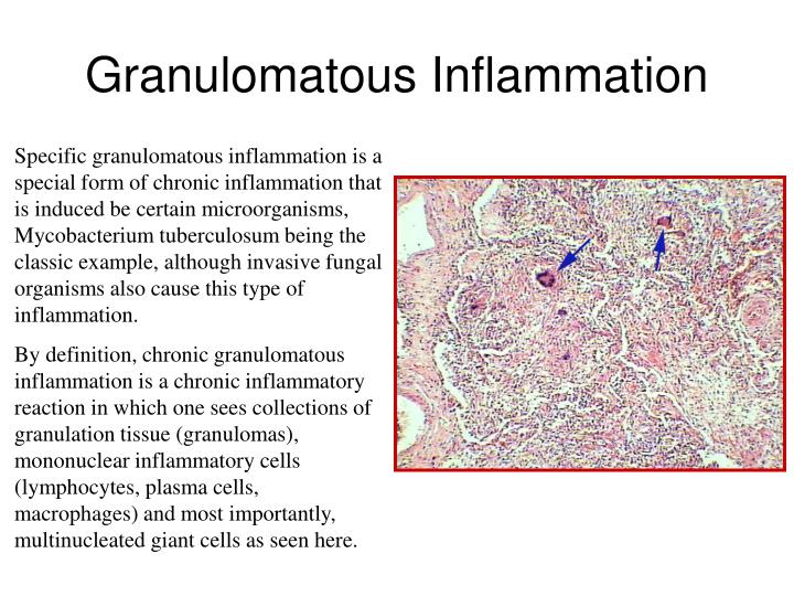 PPT - Periapical Granuloma PowerPoint Presentation - ID:4604077