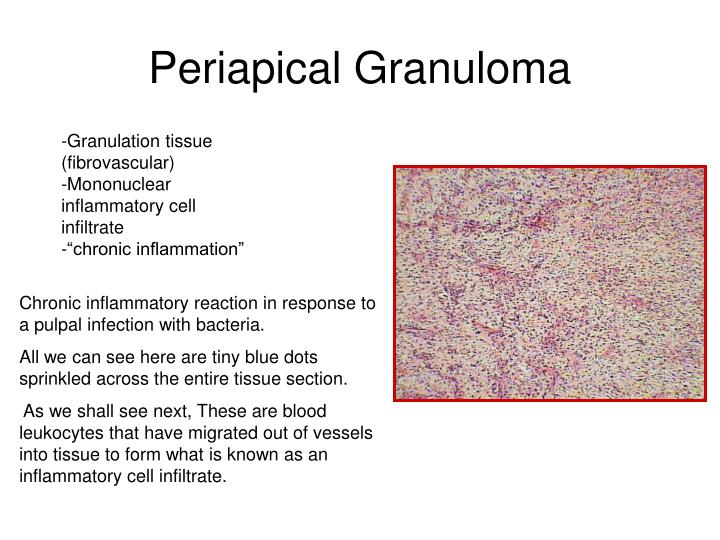 PPT - Periapical Granuloma PowerPoint Presentation - ID:4604077