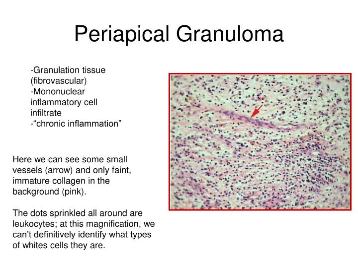 PPT - Periapical Granuloma PowerPoint Presentation - ID:4604077