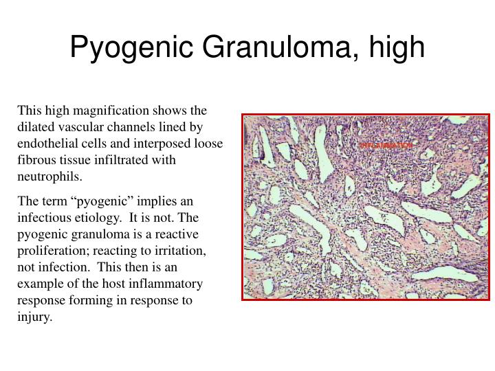 PPT - Periapical Granuloma PowerPoint Presentation - ID:4604077