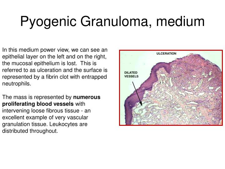 PPT - Periapical Granuloma PowerPoint Presentation - ID:4604077