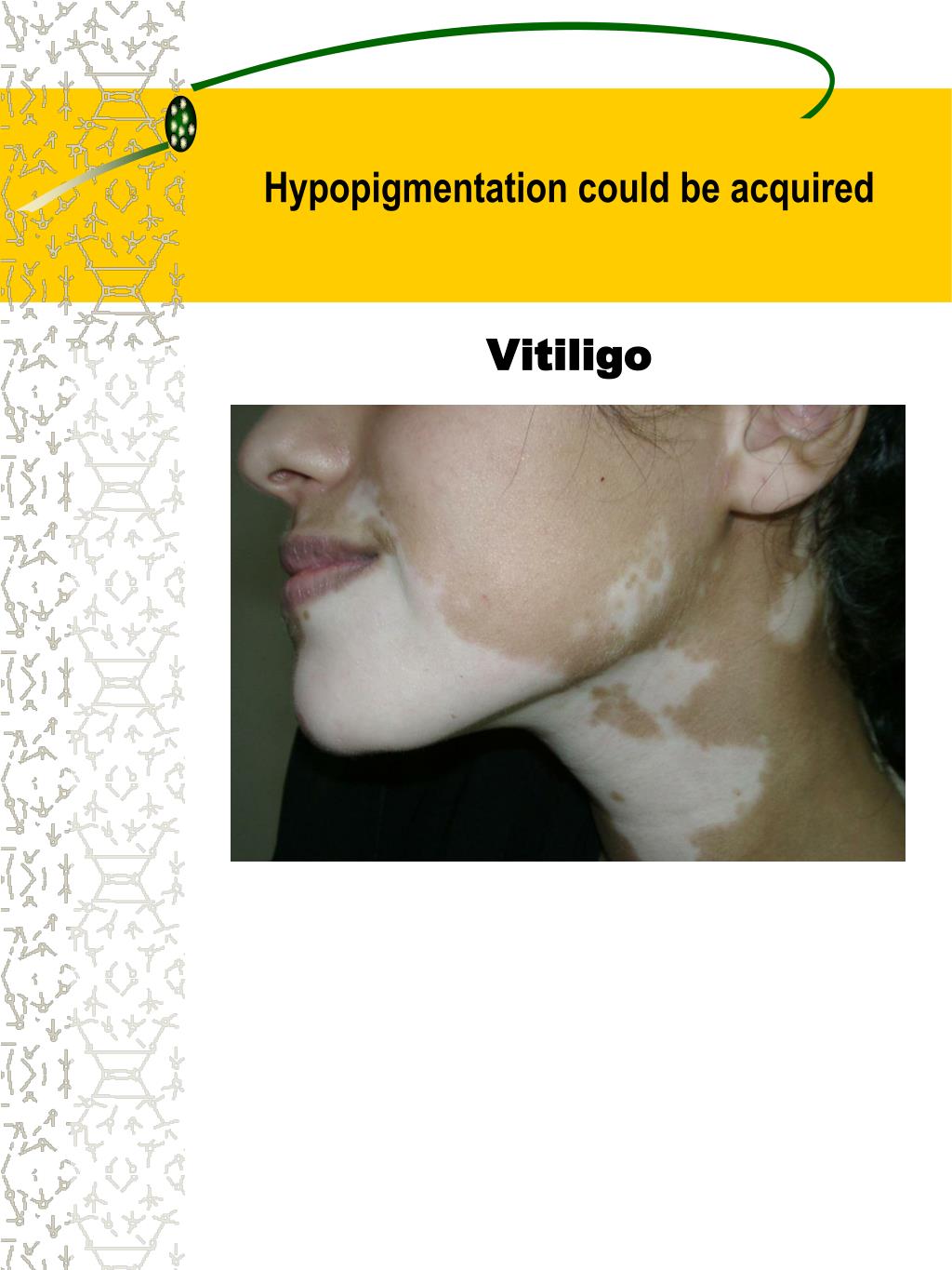 PPT - Therapeutic approaches to hypopigmentation disorder Dr. Oussama ...
