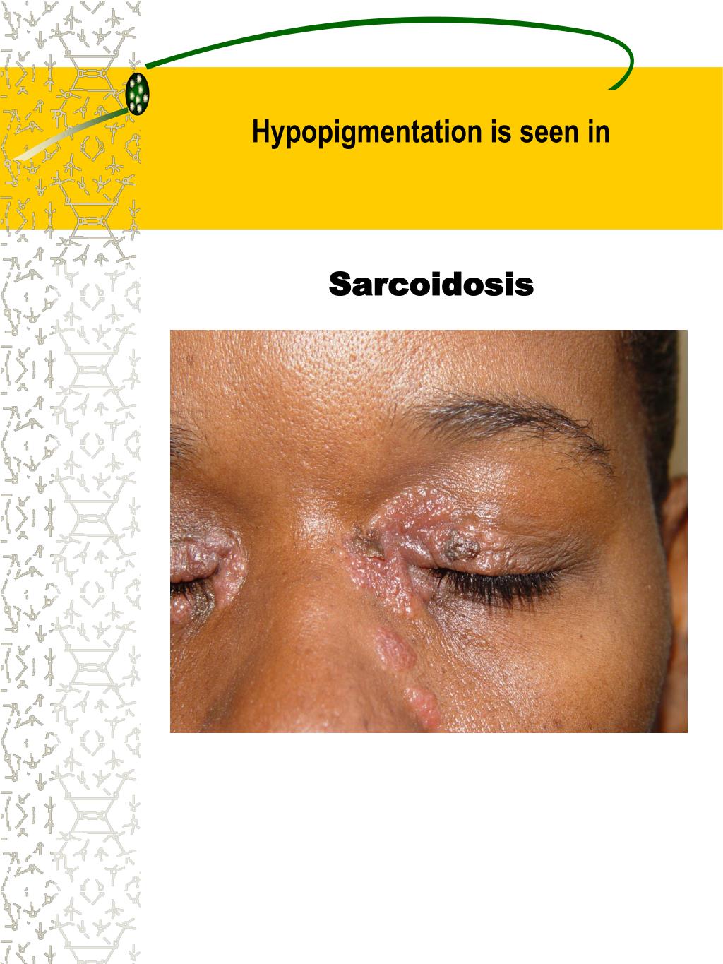 PPT - Therapeutic approaches to hypopigmentation disorder Dr. Oussama ...