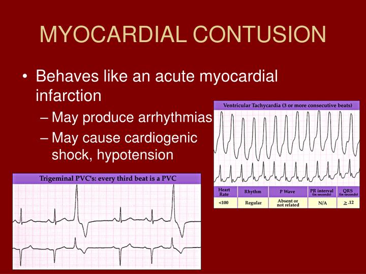 PPT - CHEST TRAUMA PowerPoint Presentation - ID:4611815