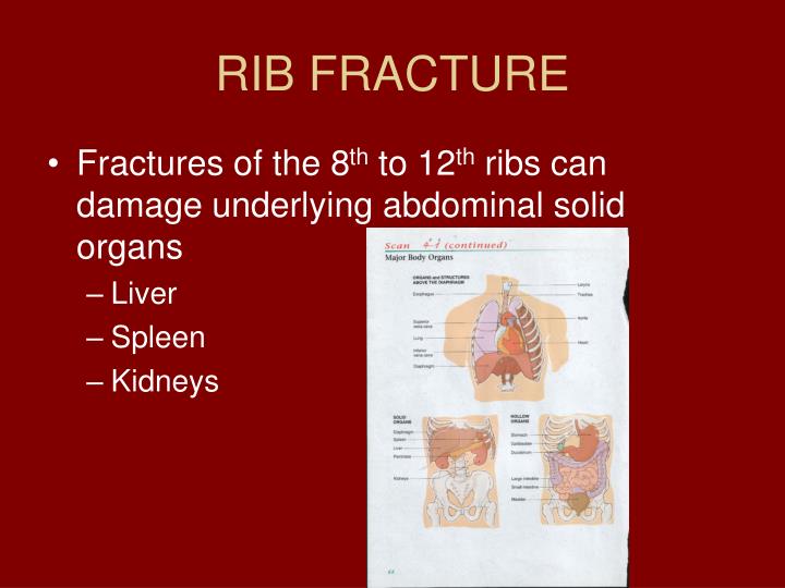 PPT - CHEST TRAUMA PowerPoint Presentation - ID:4611815