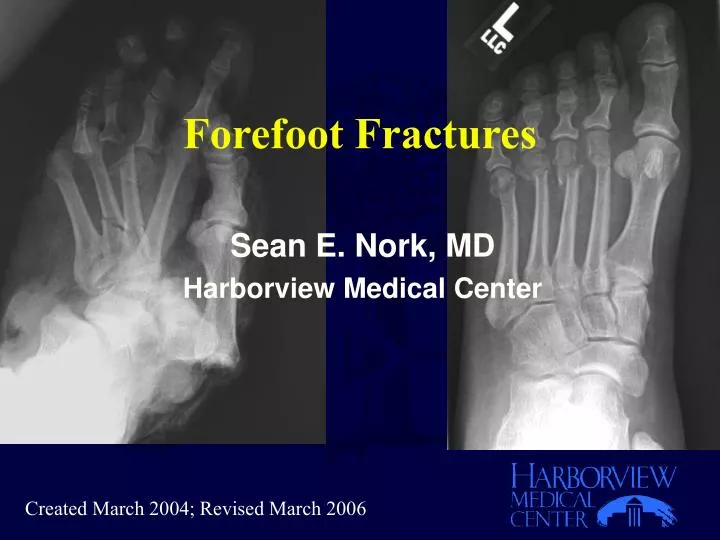 PPT - Forefoot Fractures PowerPoint Presentation, free download - ID ...