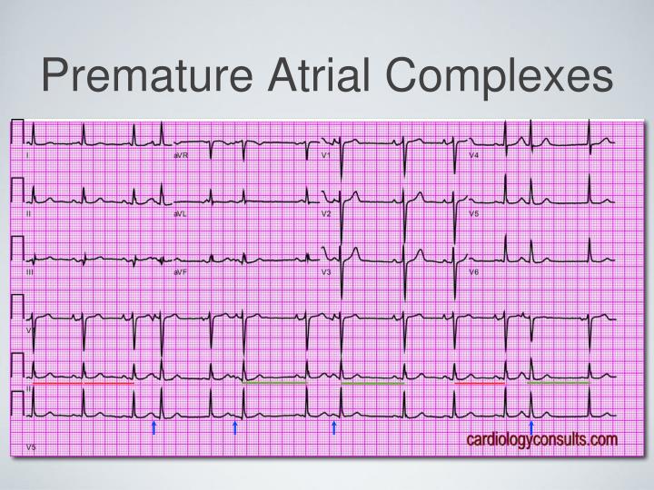 PPT - Recognizing Cardiac arrhythmias PowerPoint Presentation - ID:4613819