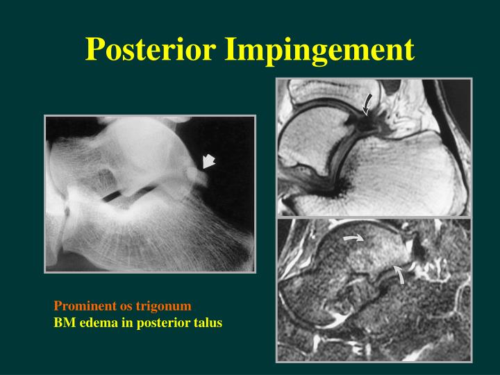 Posterior Talar Impingement _ Posterior Ankle Impingement Causes – UQMC