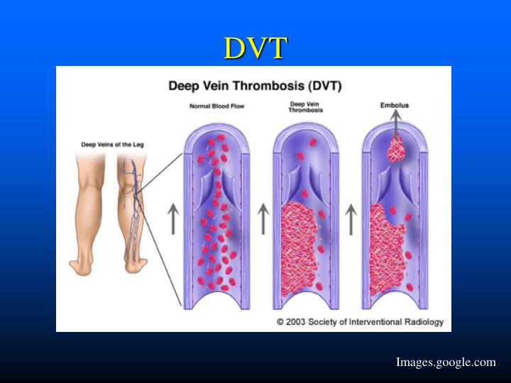 PPT - Diseases of the Pulmonary Circulation PowerPoint Presentation ...