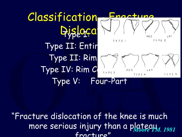 PPT - Knee Dislocation and Multiligamentous Injury PowerPoint ...