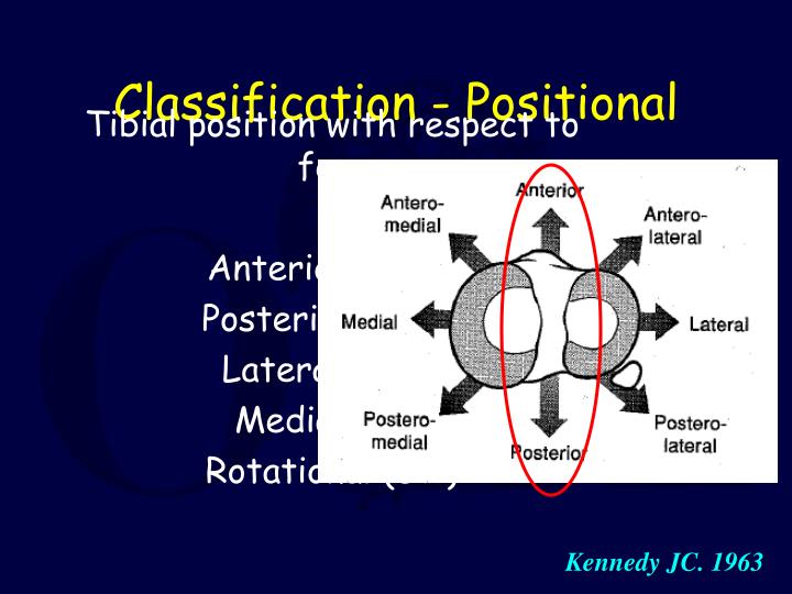 PPT - Knee Dislocation and Multiligamentous Injury PowerPoint ...