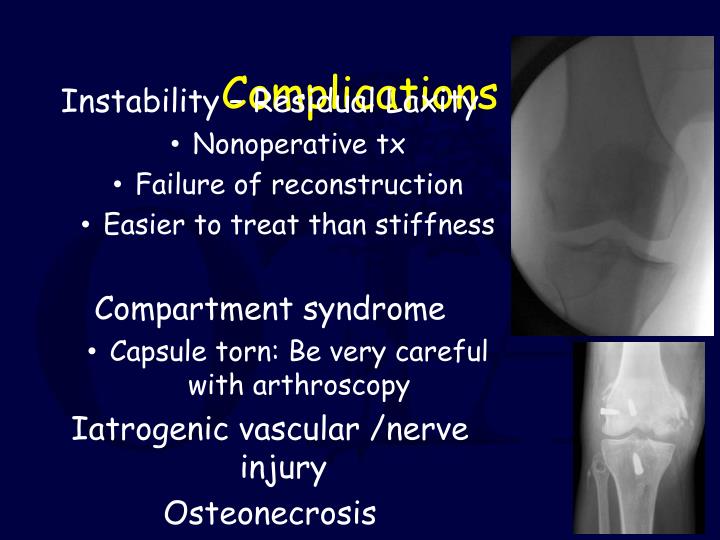 PPT - Knee Dislocation and Multiligamentous Injury PowerPoint ...