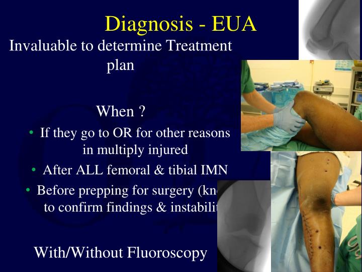 PPT - Knee Dislocation and Multiligamentous Injury PowerPoint ...