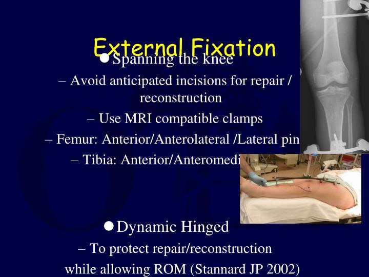 PPT - Knee Dislocation and Multiligamentous Injury PowerPoint ...