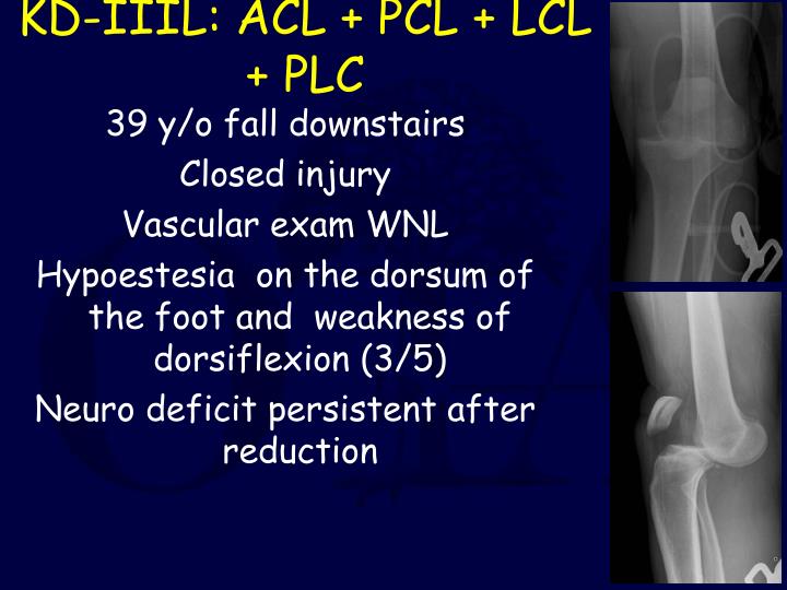 PPT - Knee Dislocation and Multiligamentous Injury PowerPoint ...