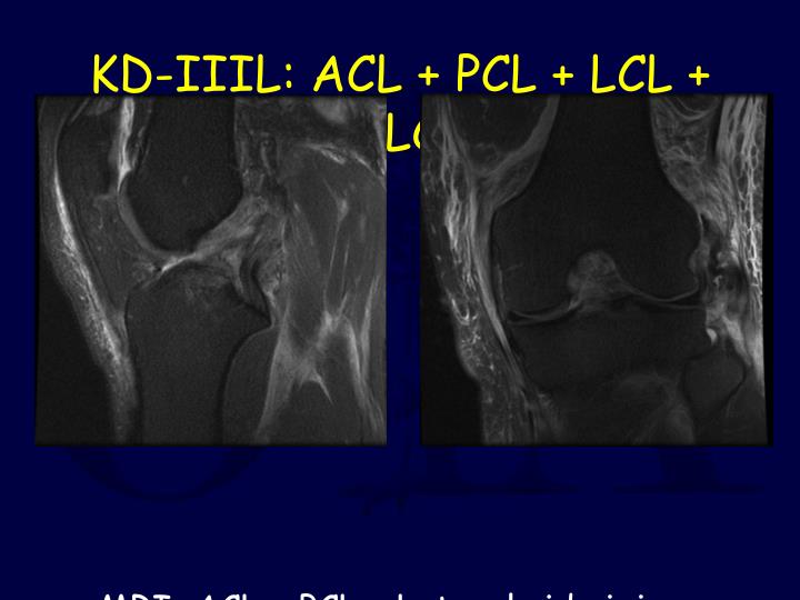 PPT - Knee Dislocation and Multiligamentous Injury PowerPoint ...