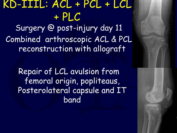PPT - Knee Dislocation and Multiligamentous Injury PowerPoint ...
