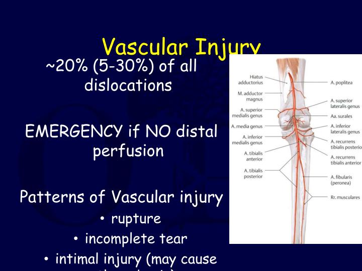 PPT - Knee Dislocation and Multiligamentous Injury PowerPoint ...