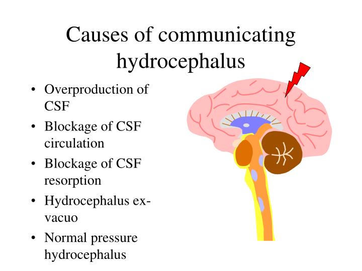 PPT - Hydrocephalus PowerPoint Presentation - ID:4628530